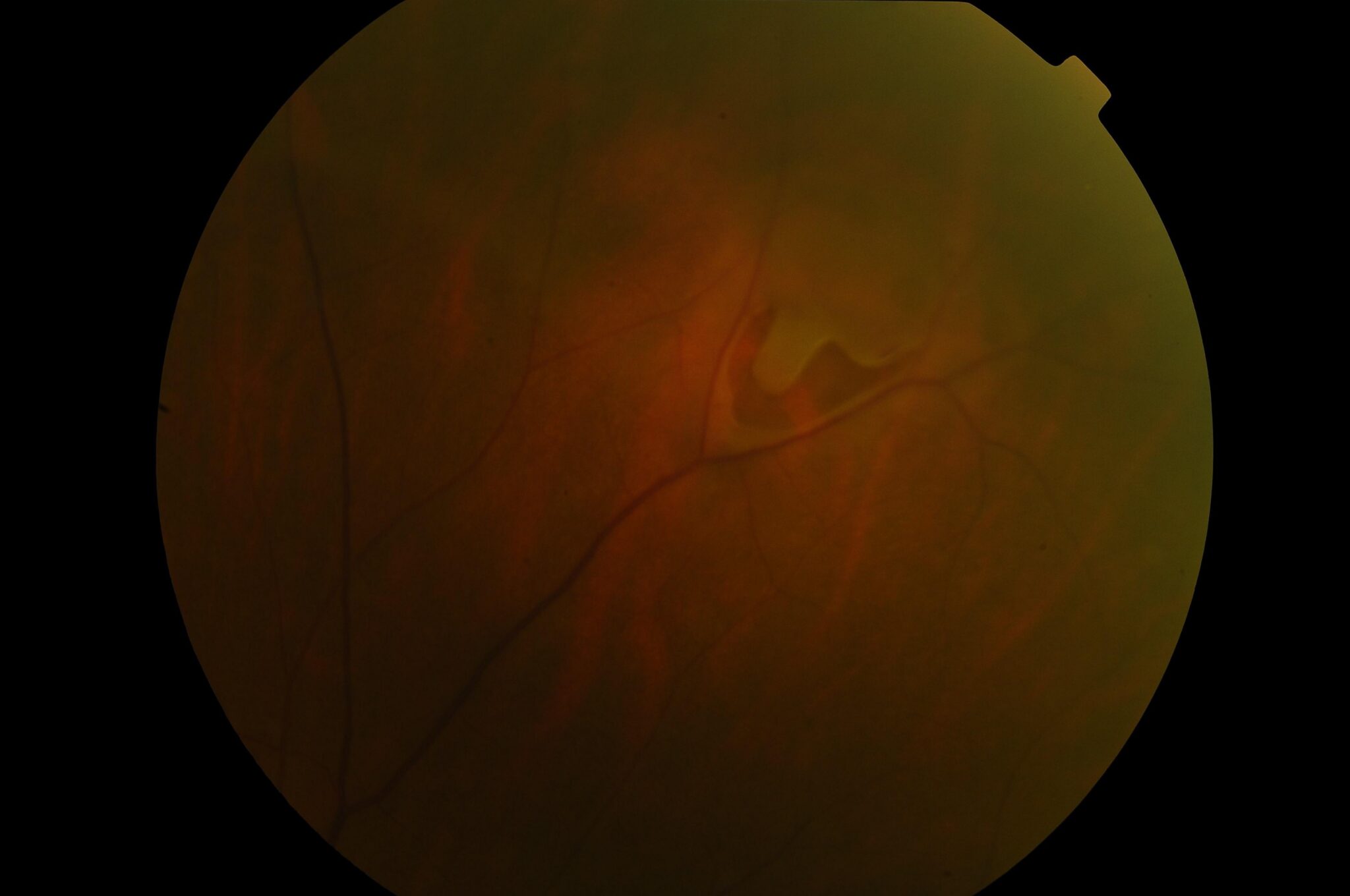 Retinal Tear or Detachment - Strathfield Retina Clinic